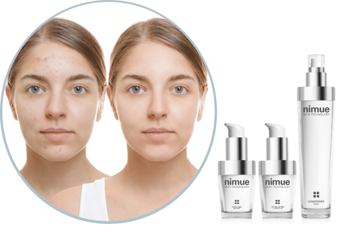 How do I use my nimue homecare starterkit?